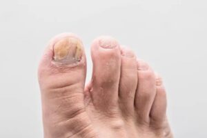 Why Do Runners' Toenails Fall Off? Causes and Tips to Avoid It